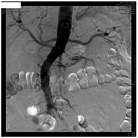 Thromboembolism as a Cause of Renal Artery Occlusion and Acute Kidney ...
