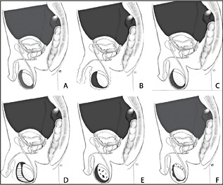 Classifying Hydroceles of the Pelvis and Groin: An Overview of Etiology ...