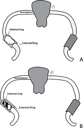 Classifying Hydroceles of the Pelvis and Groin: An Overview of Etiology ...