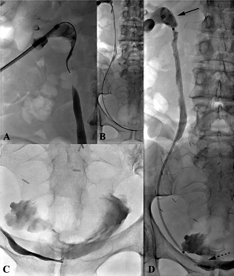 Antegrade Ureteral Stenting is a Good Alternative for the Retrograde ...