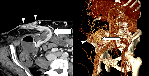 Emergency Ileal Conduit Bleeding from Peristomal Varices due to Portal ...