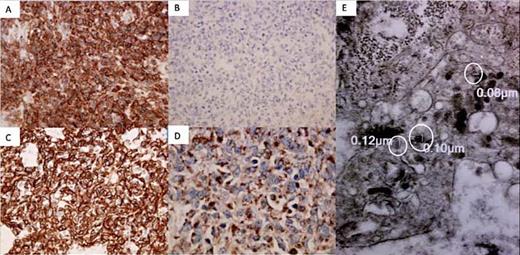 Scrotal Peripheral Primitive Neuroectodermal Tumor Current Urology