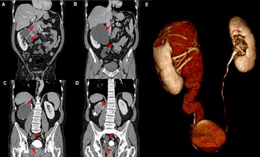 Tortuous Duplicated Collecting System Complicated by Ureterovesical ...