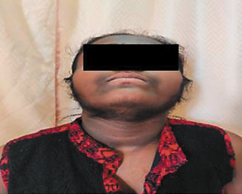 A Rare Case of Adolescent Girl with Beard-PCOS with a Difference: “HAIR ...
