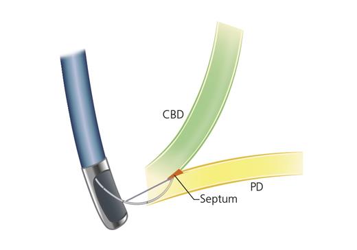 Biliary Cannulation in Endoscopic Retrograde Cholangiography: How to ...