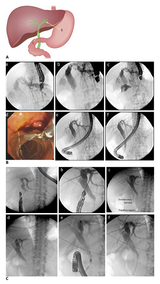 Biliary Cannulation in Endoscopic Retrograde Cholangiography: How to ...