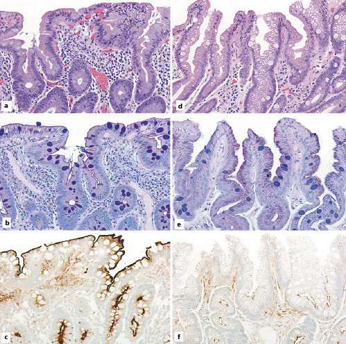 Incomplete Intestinal Metaplasia Is Rare in Autoimmune Gastritis ...