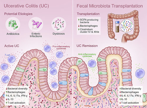 The Role of Fecal Microbiota Transplantation in the Induction of ...