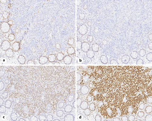 The Day-To-Day Practice of MMR and MSI Assessment in Colorectal ...