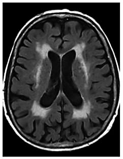 Review of Cerebral Microangiopathy and Alzheimer’s Disease: Relation ...