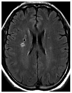 Review of Cerebral Microangiopathy and Alzheimer’s Disease: Relation ...