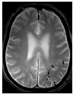 Review of Cerebral Microangiopathy and Alzheimer’s Disease: Relation ...