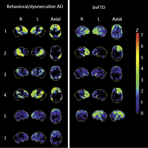 The Behavioral/Dysexecutive Variant of Alzheimer’s Disease: A Case ...