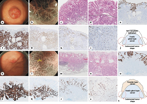 Clinicopathological and Endoscopic Features of Raspberry-Shaped Gastric ...