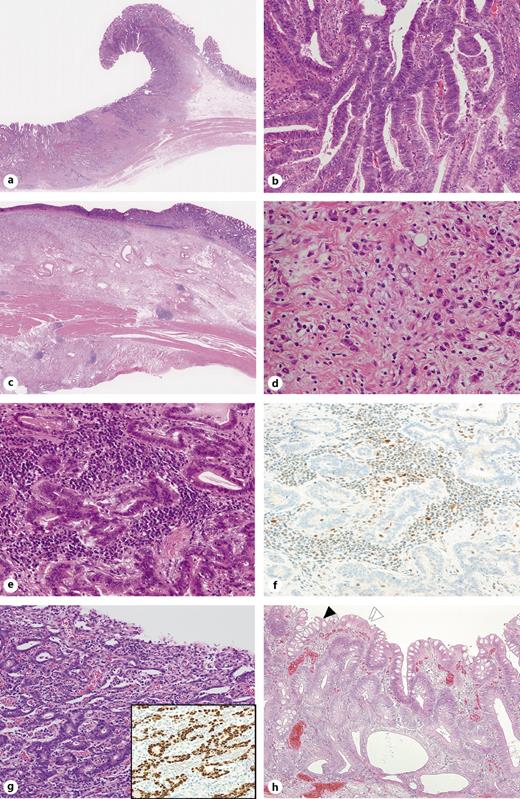 Pathological Diversity of Gastric Cancer from the Viewpoint of ...