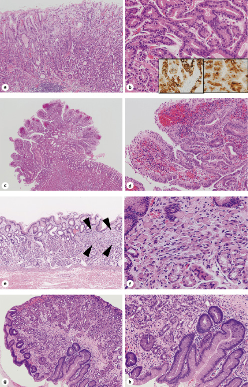 Pathological Diversity of Gastric Cancer from the Viewpoint of ...