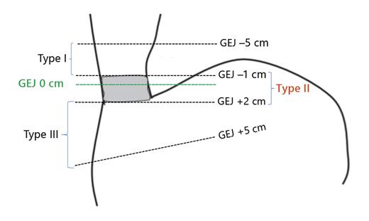 Is There an Increasing Incidence of Gastroesophageal Junctional ...