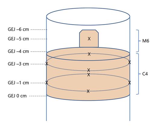 Is There an Increasing Incidence of Gastroesophageal Junctional ...