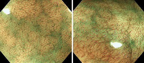 Possible Role of Image-Enhanced Endoscopy in the Evaluation of Mucosal ...
