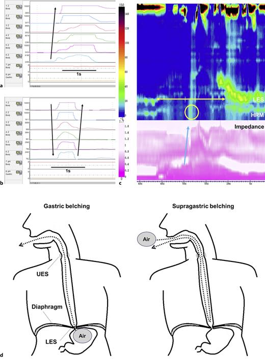Belching Disorders and Rumination Syndrome: A Literature Review ...
