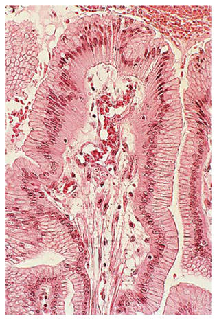 Gastric Antral Vascular Ectasia (GAVE): An Update on Clinical ...