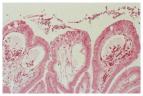 Gastric Antral Vascular Ectasia (GAVE): An Update on Clinical ...
