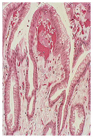 Gastric Antral Vascular Ectasia (GAVE): An Update on Clinical ...