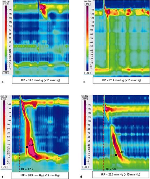 Diagnosis and Treatment Strategy of Achalasia Subtypes and ...
