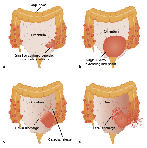 Guidelines for Colonic Diverticular Bleeding and Colonic Diverticulitis ...
