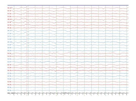 Butane Toxicity: The Curse of Volatile Solvent Abuse | Dubai Medical ...