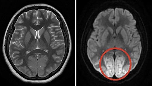 Butane Toxicity: The Curse of Volatile Solvent Abuse | Dubai Medical ...