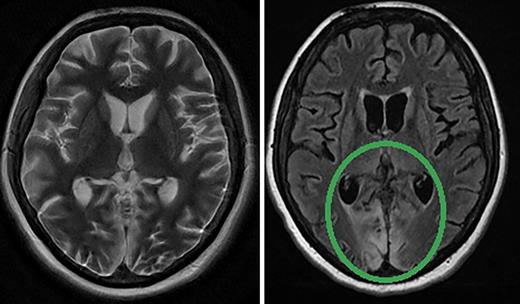 Butane Toxicity: The Curse of Volatile Solvent Abuse | Dubai Medical ...