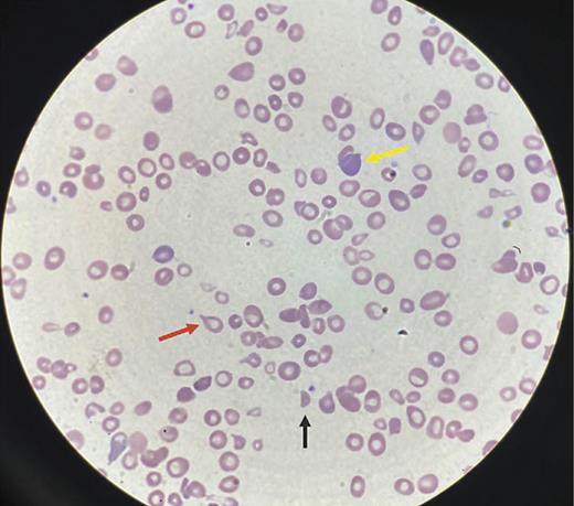 Demystifying the Mystery of Vitamin B12 Deficiency in an Infant with ...