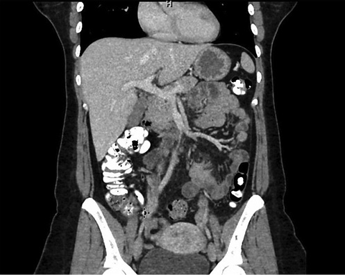 Small Intestine Perforation due to Foreign Body: Case Report | Dubai ...