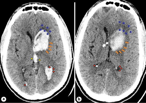 Upper Extremity Deep Vein Thrombosis in a Patient with Spontaneous ...