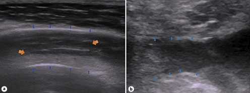 Upper Extremity Deep Vein Thrombosis in a Patient with Spontaneous ...