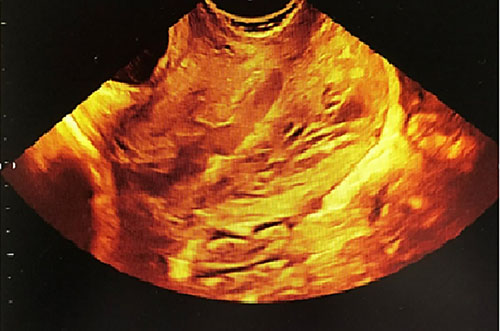 Cervical Varix Associated with Placenta Previa: A Case Report | Dubai ...