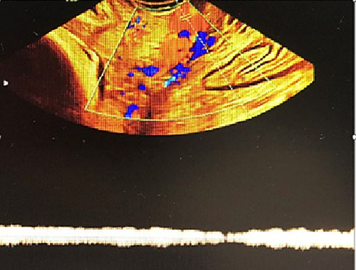 Cervical Varix Associated with Placenta Previa: A Case Report | Dubai ...