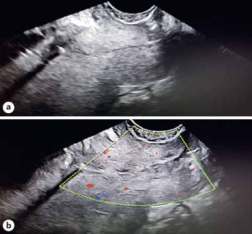 Cervical Varix Associated with Placenta Previa: A Case Report | Dubai ...