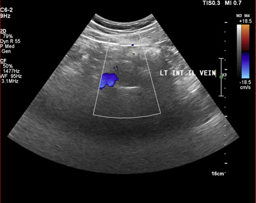 Unprovoked Extensive Deep Vein Thrombosis due to May-Thurner Syndrome ...