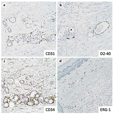 Diagnostic Immunohistochemistry in Cutaneous Neoplasia: An Update ...