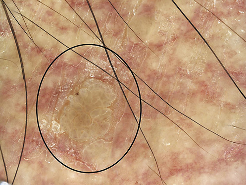 Sign of Leser-Trélat and Cutaneous T-Cell Lymphoma: A Rare Association ...