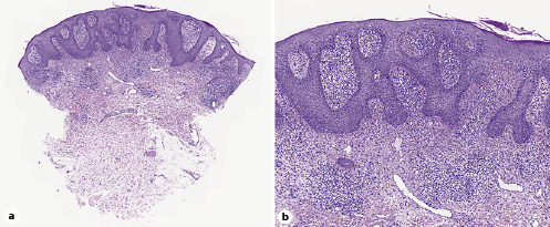 Sign of Leser-Trélat and Cutaneous T-Cell Lymphoma: A Rare Association ...