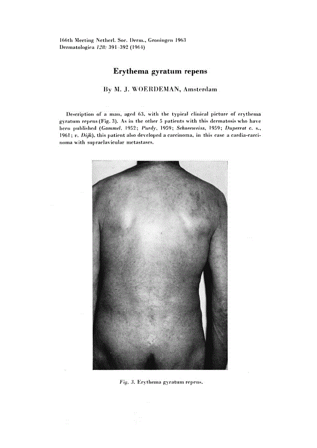 Erythema gyratum repens | Dermatology | Karger Publishers