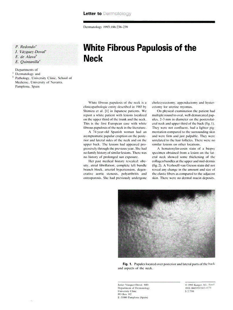 White Fibrous Papulosis of the Neck | Dermatology | Karger Publishers