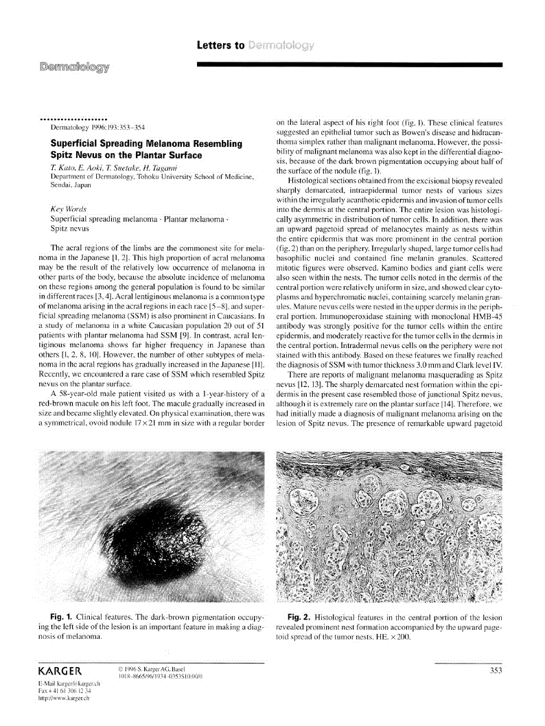Superficial Spreading Melanoma Resembling Spitz Nevus on the Plantar ...