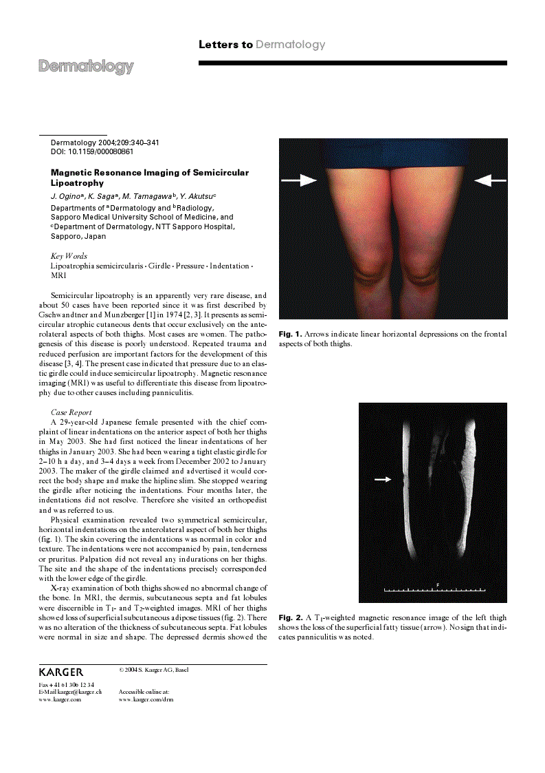 Magnetic Resonance Imaging of Semicircular Lipoatrophy | Dermatology ...