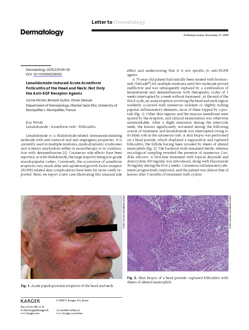 Lenalidomide-Induced Acute Acneiform Folliculitis of the Head and Neck ...