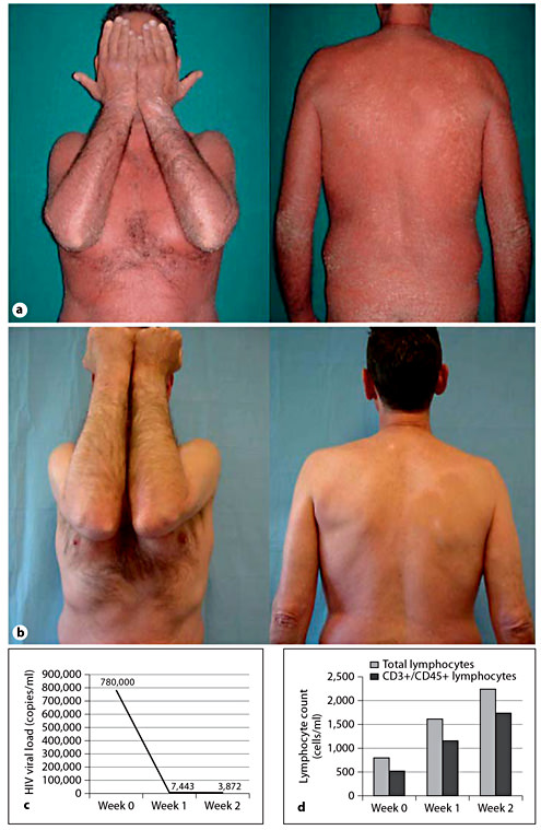 Complete Resolution of Erythrodermic Psoriasis in an HIV and HCV ...