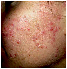 Strategic Targets in Acne: The Comedone Switch in Question ...